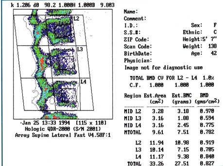 Giovanni's house: Identification of vertebral fractures